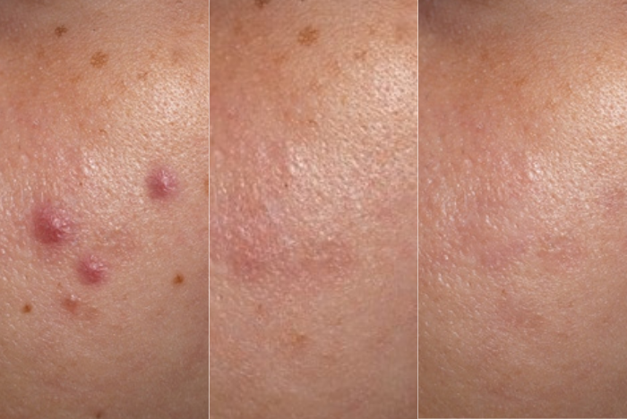 Powerful Acne Treatments to Unlock Clear Skin: Airol-N Face Wash and A ...