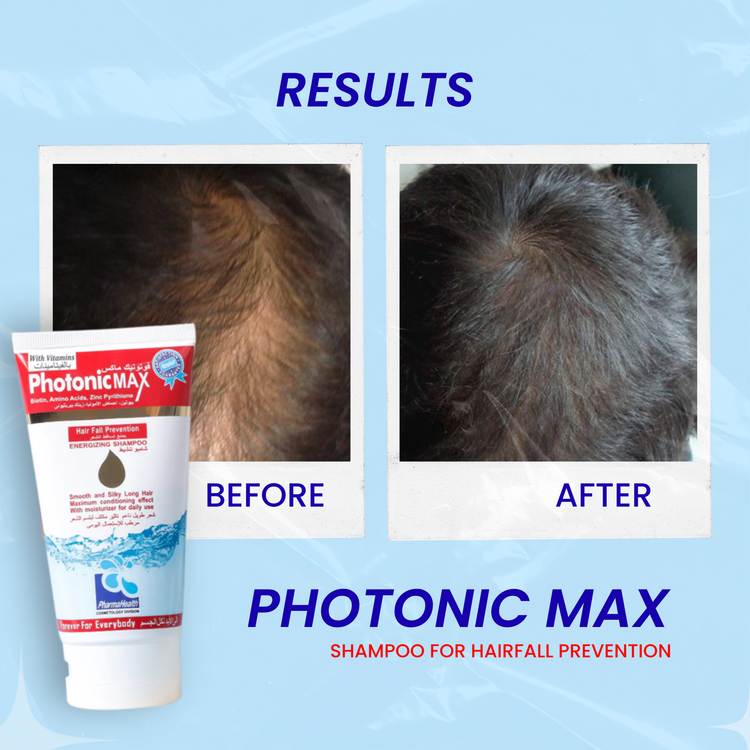 Photonic MAX Shampoo for Hairfall Prevention – PHARMA HEALTH